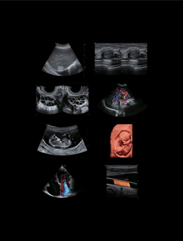 SonoScape P20 Ultrasound Machine | Value and Significance | Bionexmed